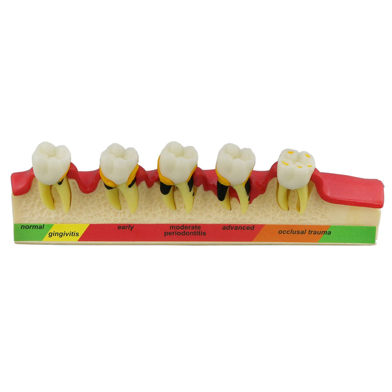Teeth Periodontal Disease Model Dental Caries Breakdown Display ...