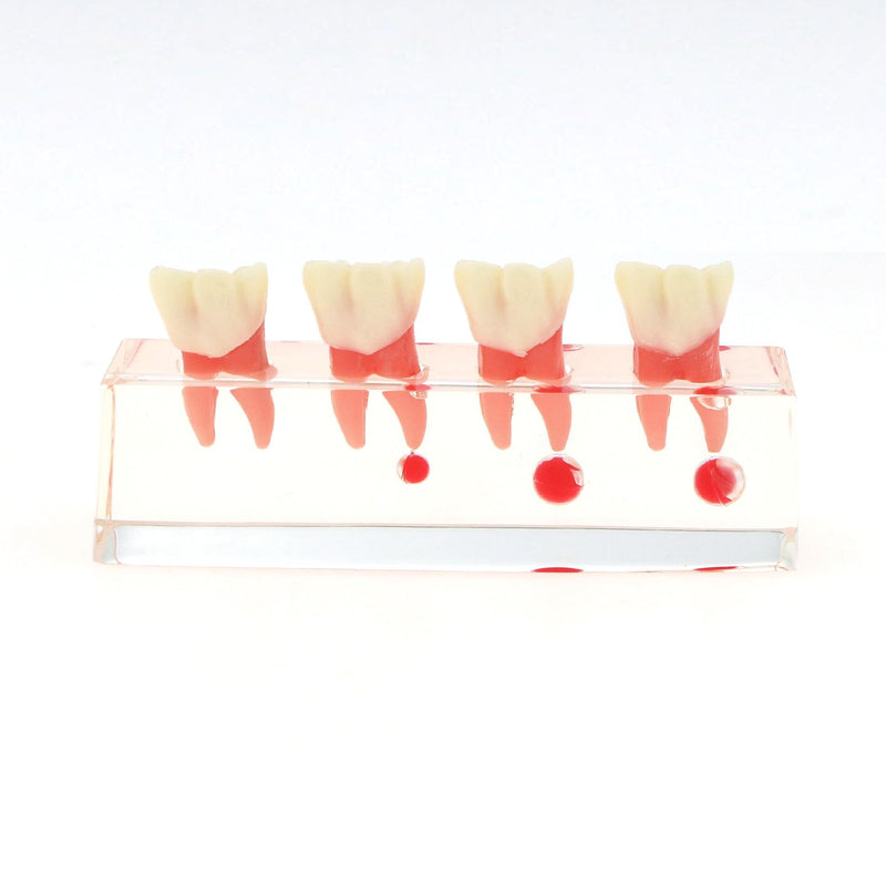 Dental 4-stage Endodontic Treatment Model for Study Teach Teeth Model ...